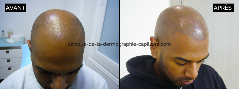 21-1-Effet-crane-rase-homme-apres – Clinique de la dermographie capillaire