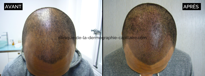 6-Effect-crane-rase-homme-apres – Clinique de la dermographie capillaire