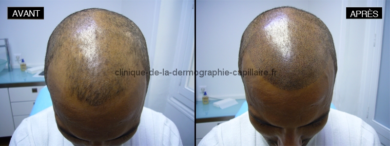 7-Avant-Apres.-Effet-crane-rase-Homme – Clinique de la dermographie ...