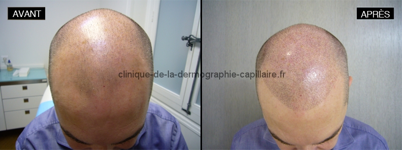 9-Avant-Apres.-Effet-crane-rase-Homme – Clinique de la dermographie ...
