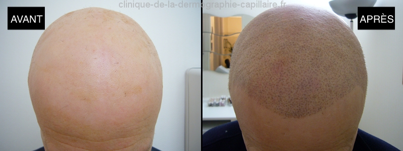 Densification-cuir-chevelu-effet-crane-rase-Apres – Clinique de la ...