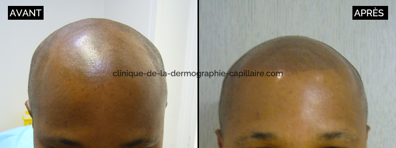 effet-crane-rase-01 – Clinique de la dermographie capillaire