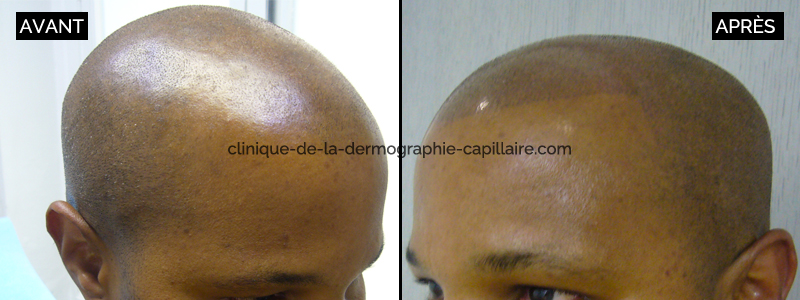 effet-crane-rase-02 – Clinique de la dermographie capillaire