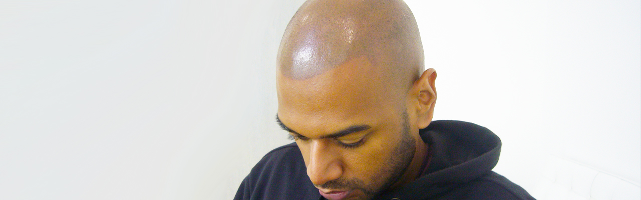 crane-rase – Clinique de la dermographie capillaire