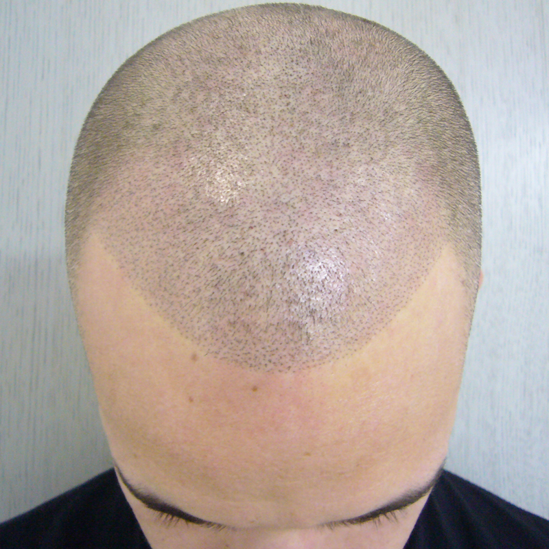 crane-rase2 – Clinique de la dermographie capillaire